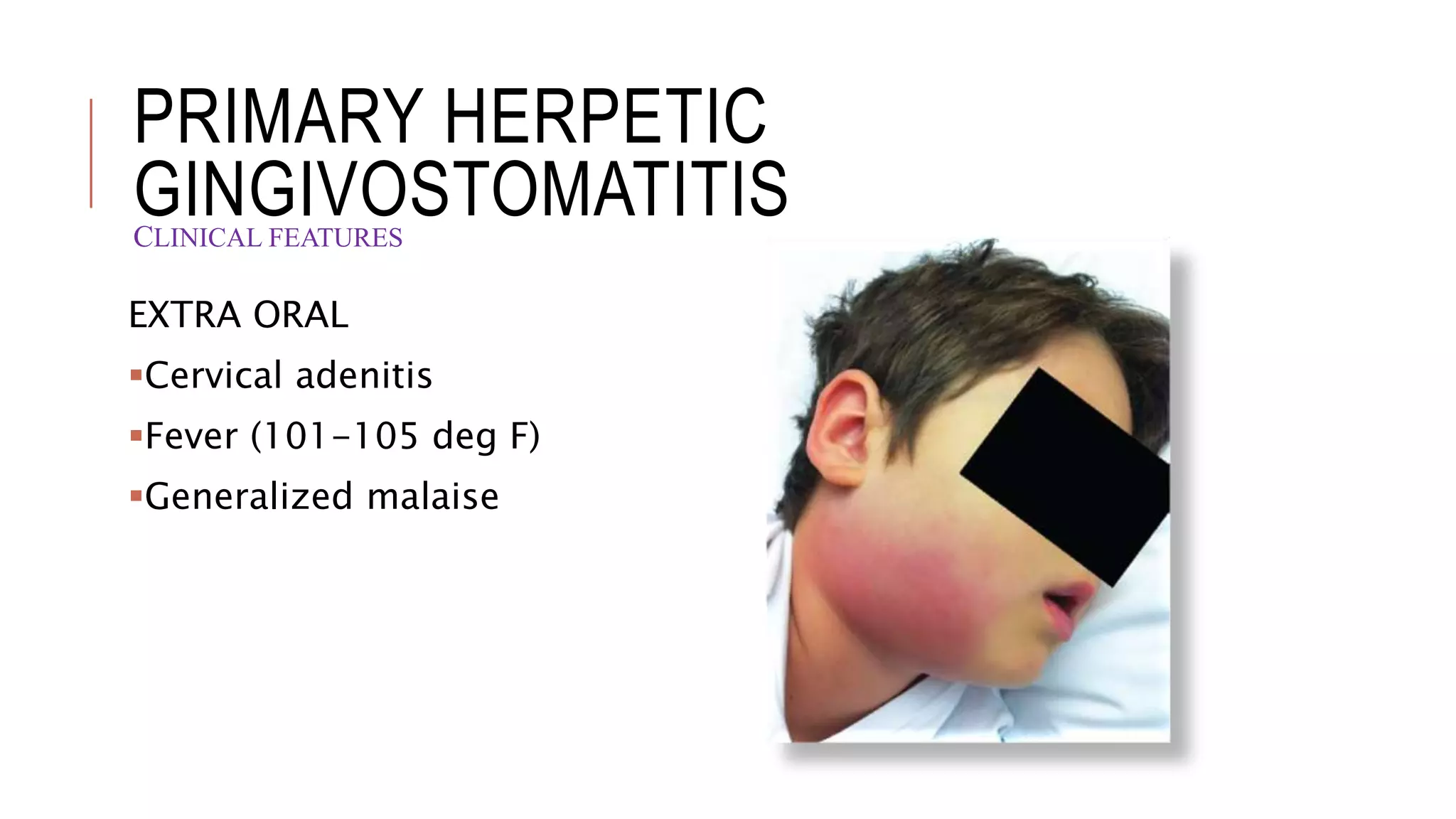Acute Gingival Infections | PPTX