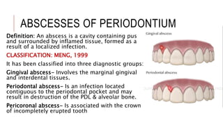 Acute Gingival Infections | PPTX