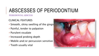 Acute Gingival Infections | PPTX