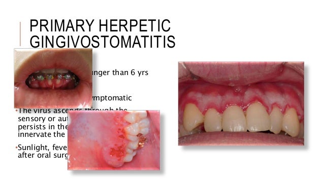 Secondary Herpetic Gingivostomatitis Blistering Disease | SpringerLink