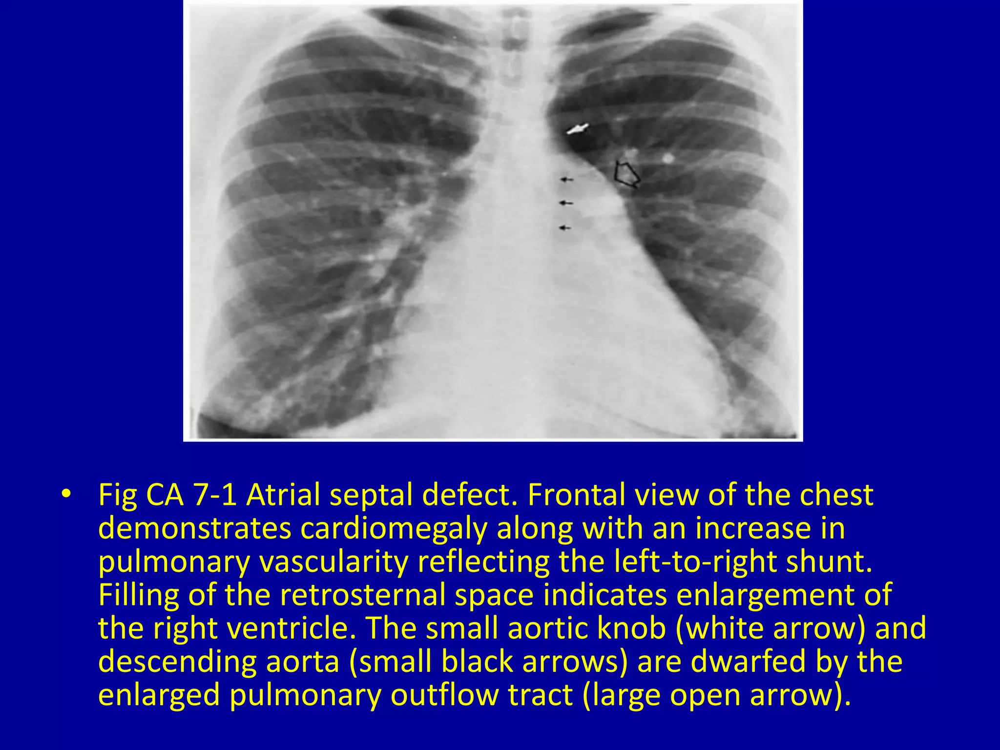 7 acyanotic congenital heart disease with increased pulmonary | PPTX