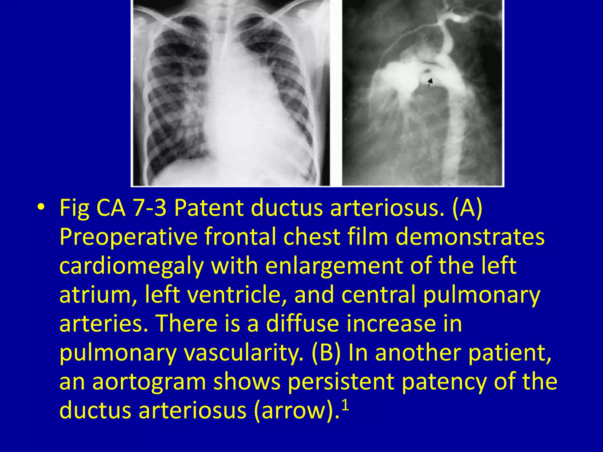 7 acyanotic congenital heart disease with increased pulmonary | PPTX