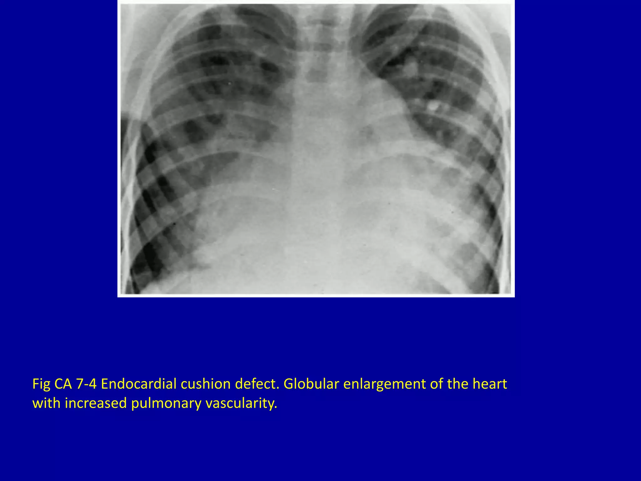 7 acyanotic congenital heart disease with increased pulmonary | PPTX