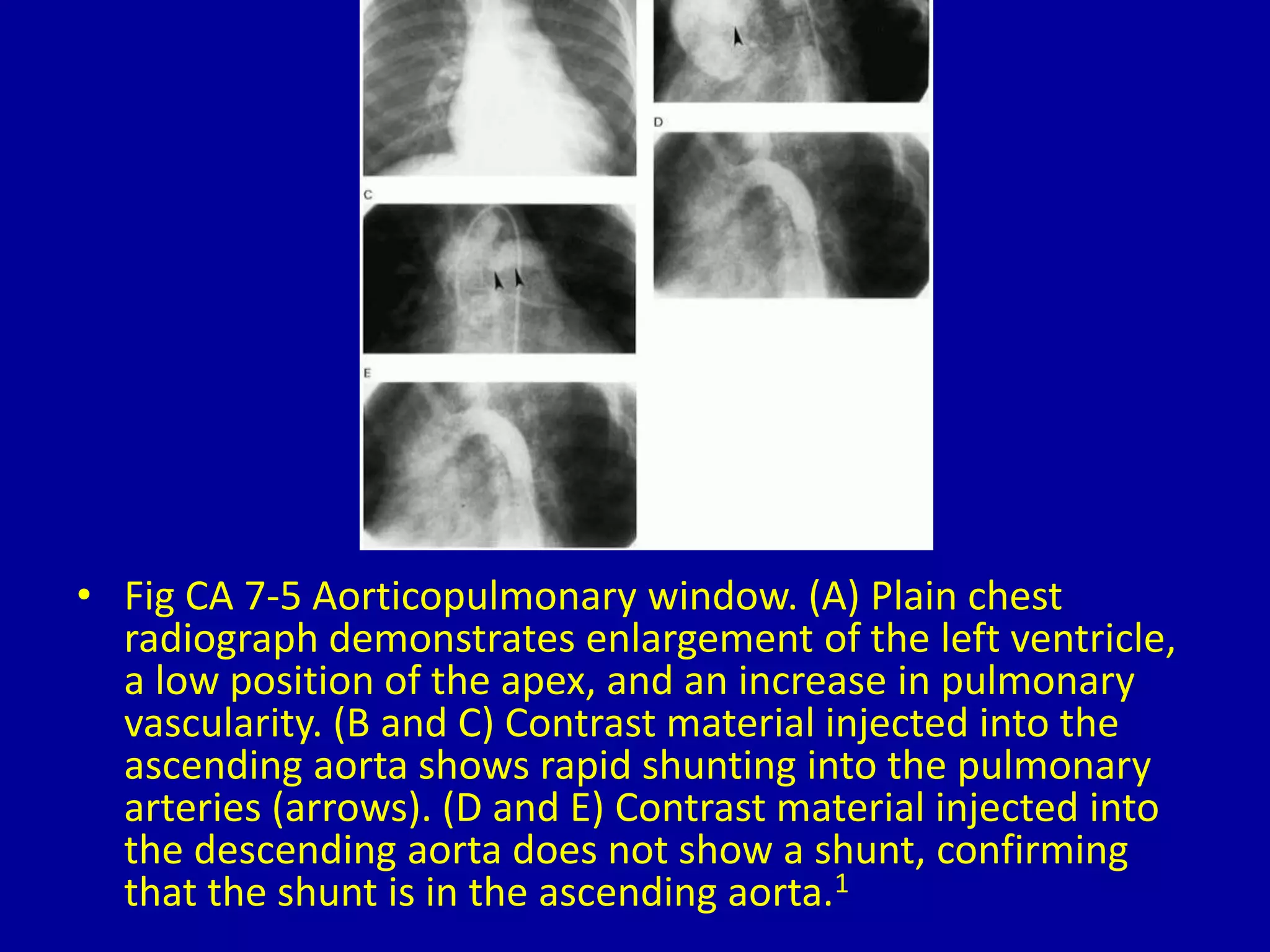 7 acyanotic congenital heart disease with increased pulmonary | PPTX