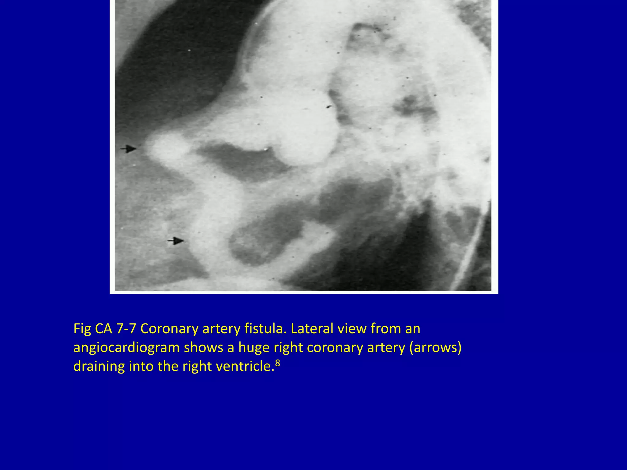 7 acyanotic congenital heart disease with increased pulmonary | PPTX