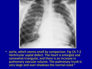 7 acyanotic congenital heart disease with increased pulmonary | PPTX