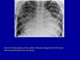 7 acyanotic congenital heart disease with increased pulmonary | PPTX