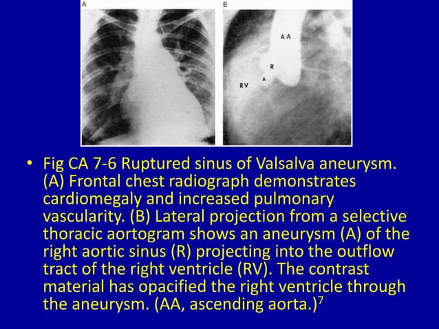 7 acyanotic congenital heart disease with increased pulmonary | PPTX ...