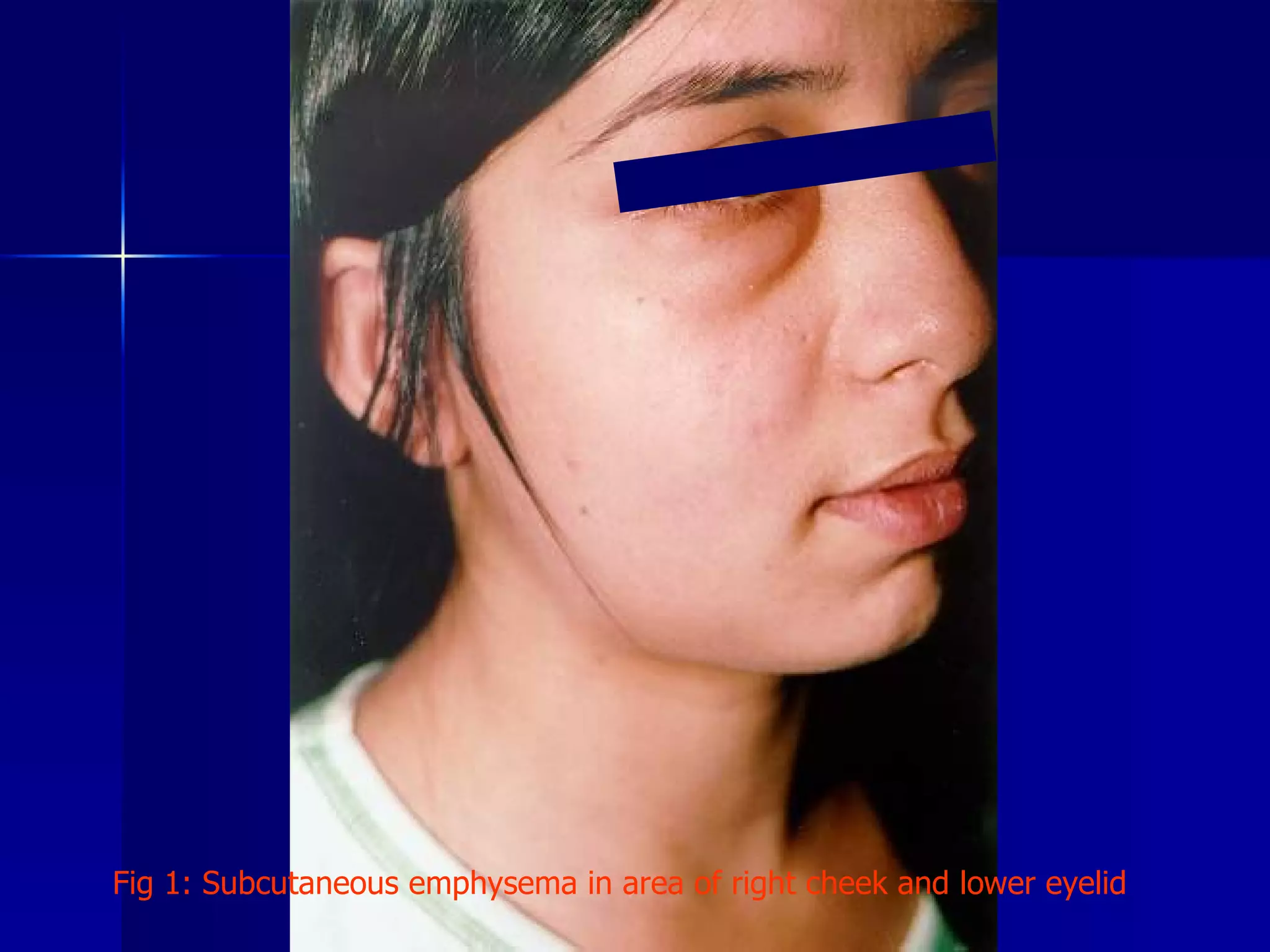 Subcutaneous emphysema as a complication of tooth extraction ...