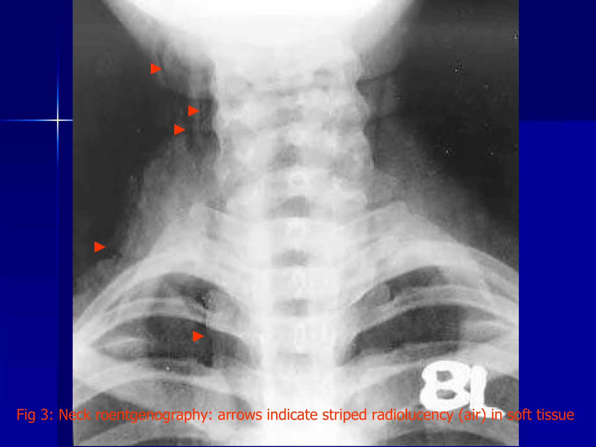 Subcutaneous emphysema as a complication of tooth extraction ...