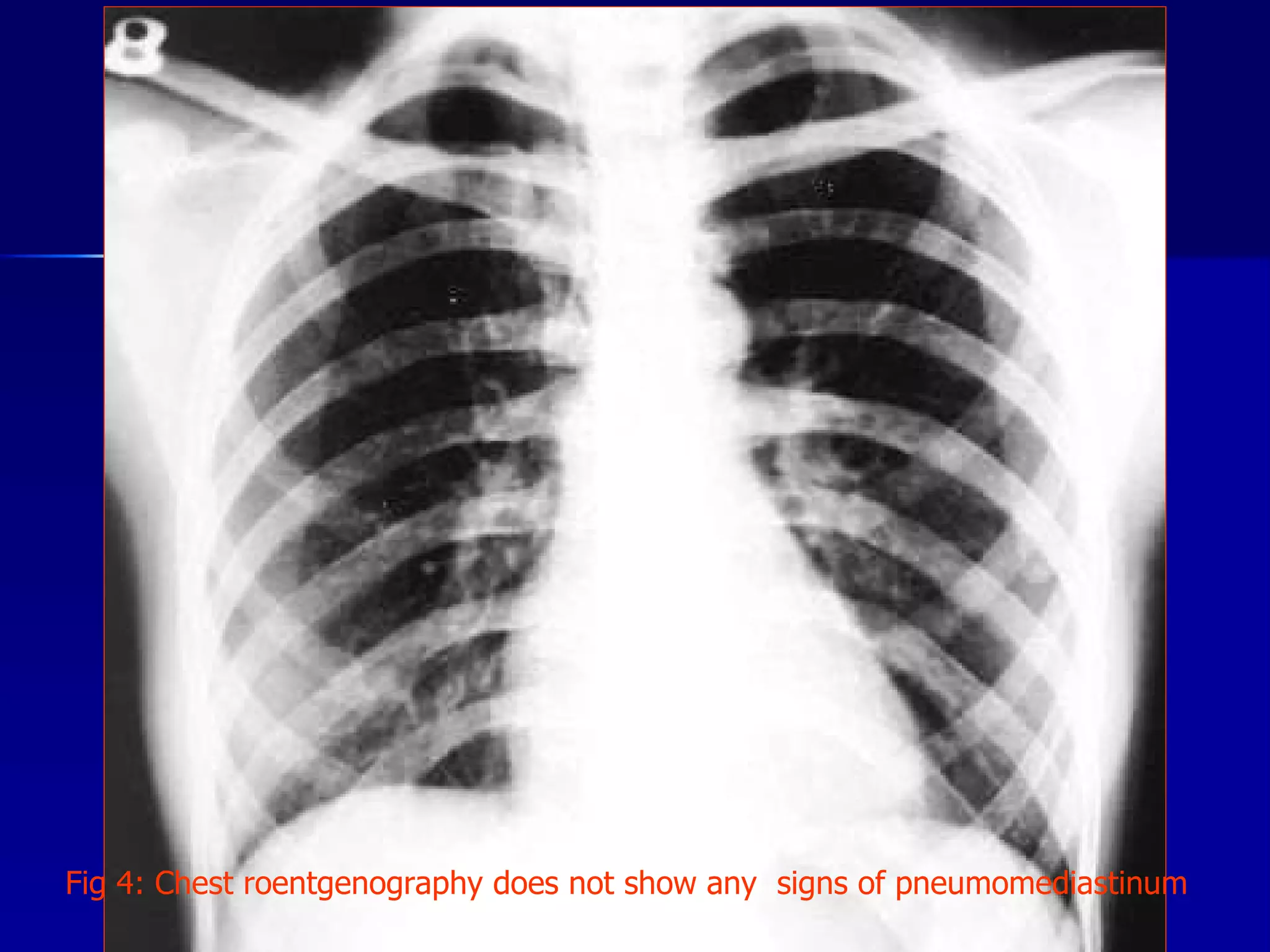 Subcutaneous emphysema as a complication of tooth extraction ...
