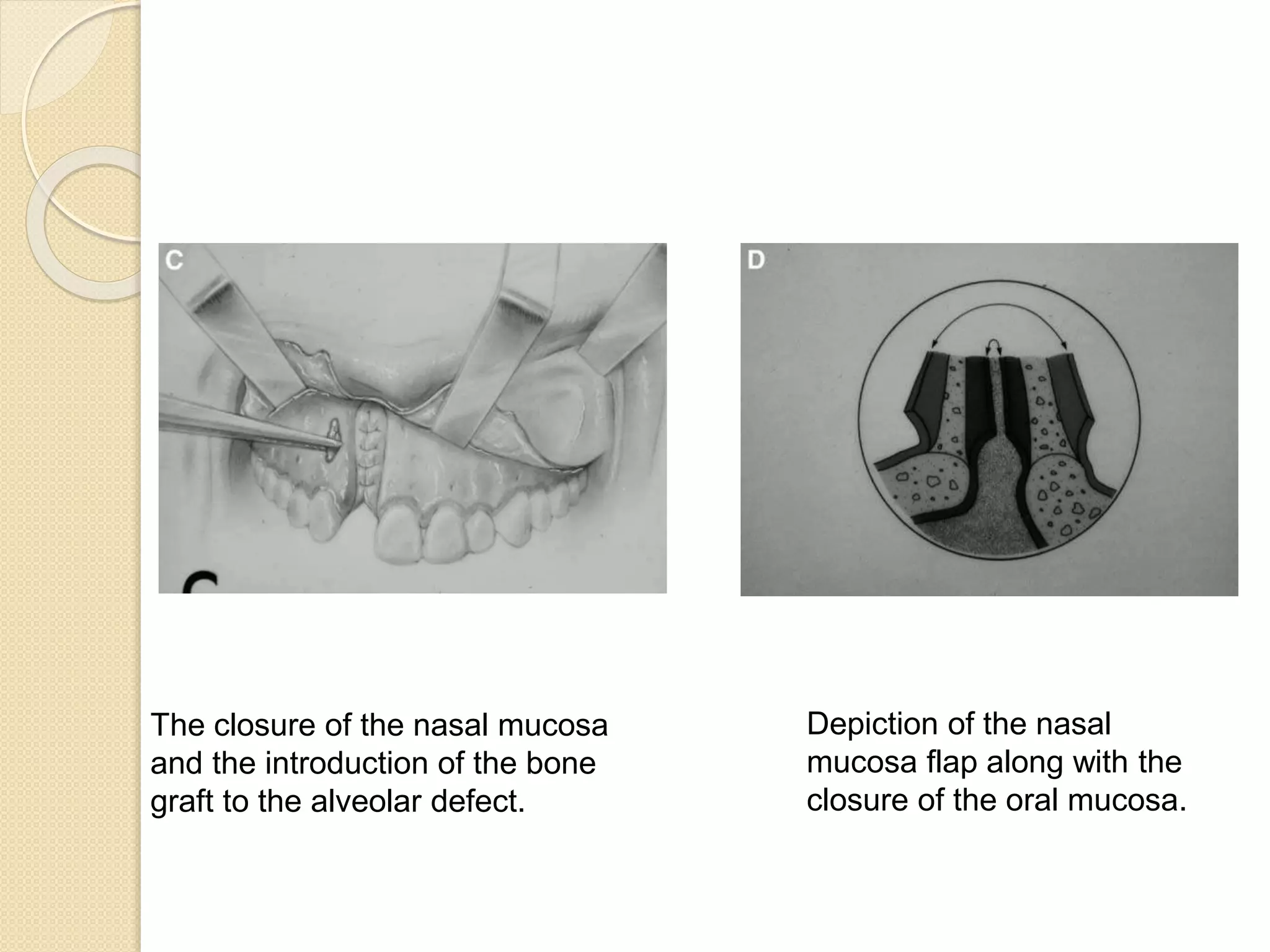 alveolar bone grafting | PPTX