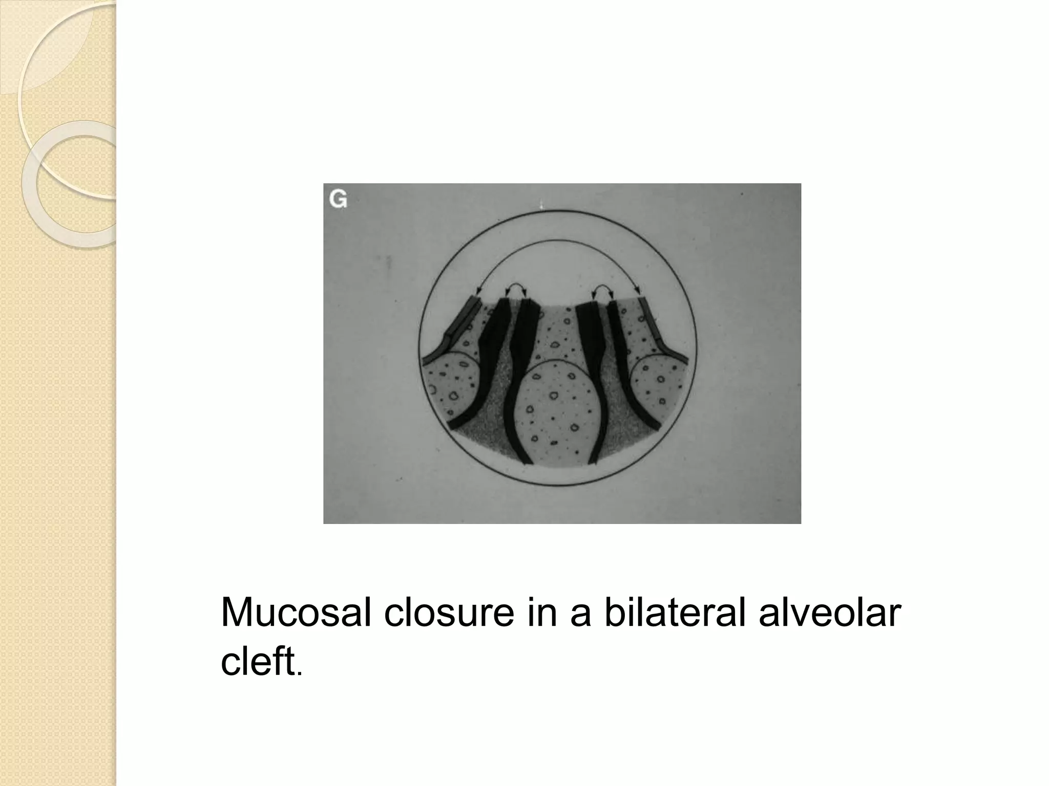 alveolar bone grafting | PPTX