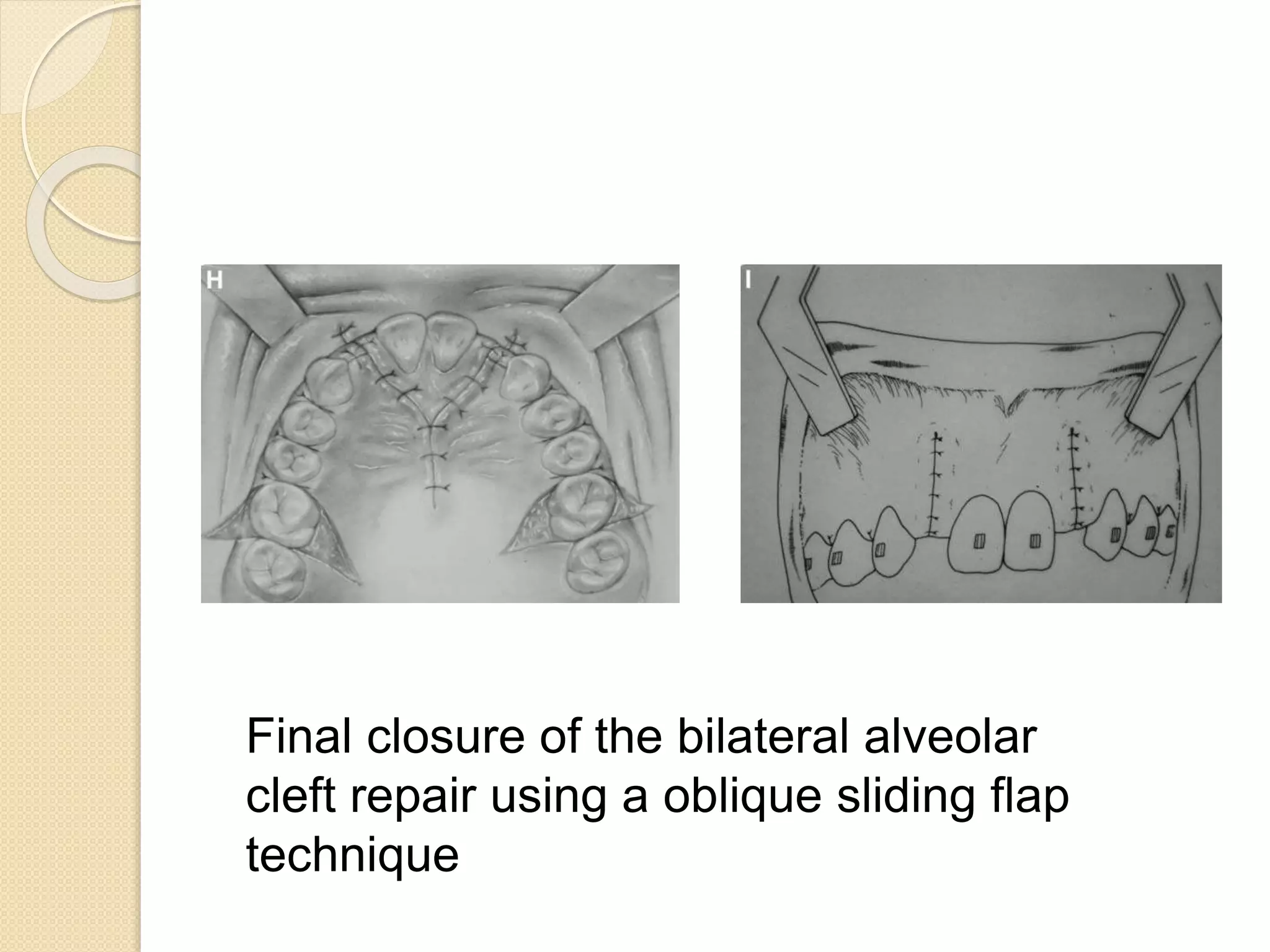 alveolar bone grafting | PPTX
