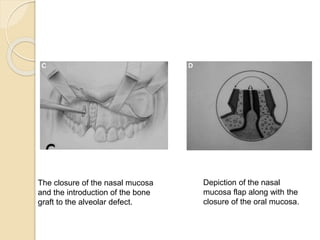 alveolar bone grafting | PPTX