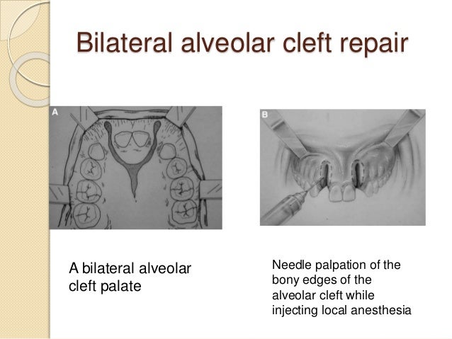 alveolar bone grafting