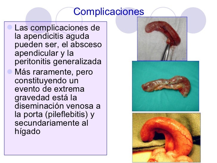 7. Apendicitis Aguda