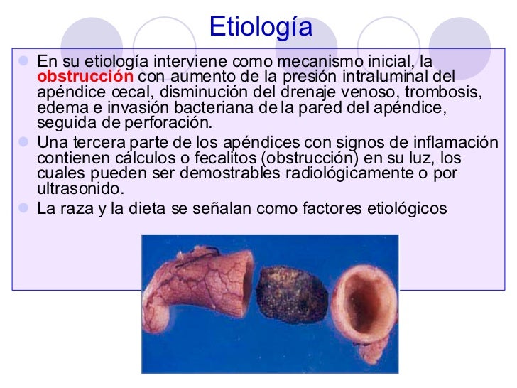 7. Apendicitis Aguda