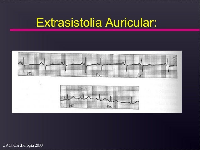 7 arritmias supraventriculares