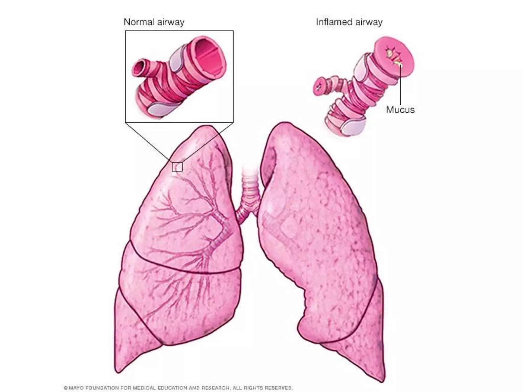 Asthma- Easy PPT for Nursing Students | PDF