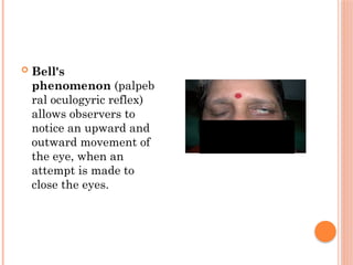 7 bells palsy by dr ishika_saxenaa .pptx