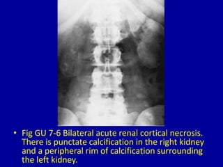 7 bilateral large, smooth kidneys | PPTX | Digestive Disorders ...