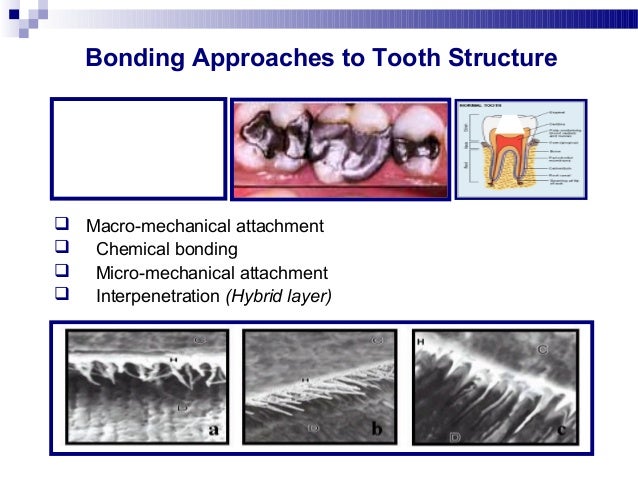 bonding to tooth structure dental material