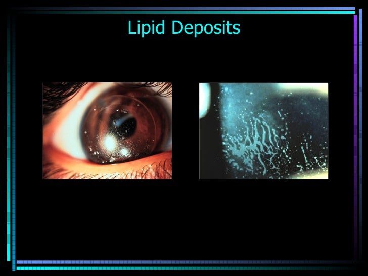 care and maintenance of soft contact lenses