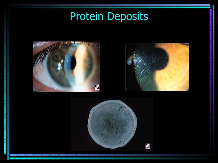care and maintenance of soft contact lenses