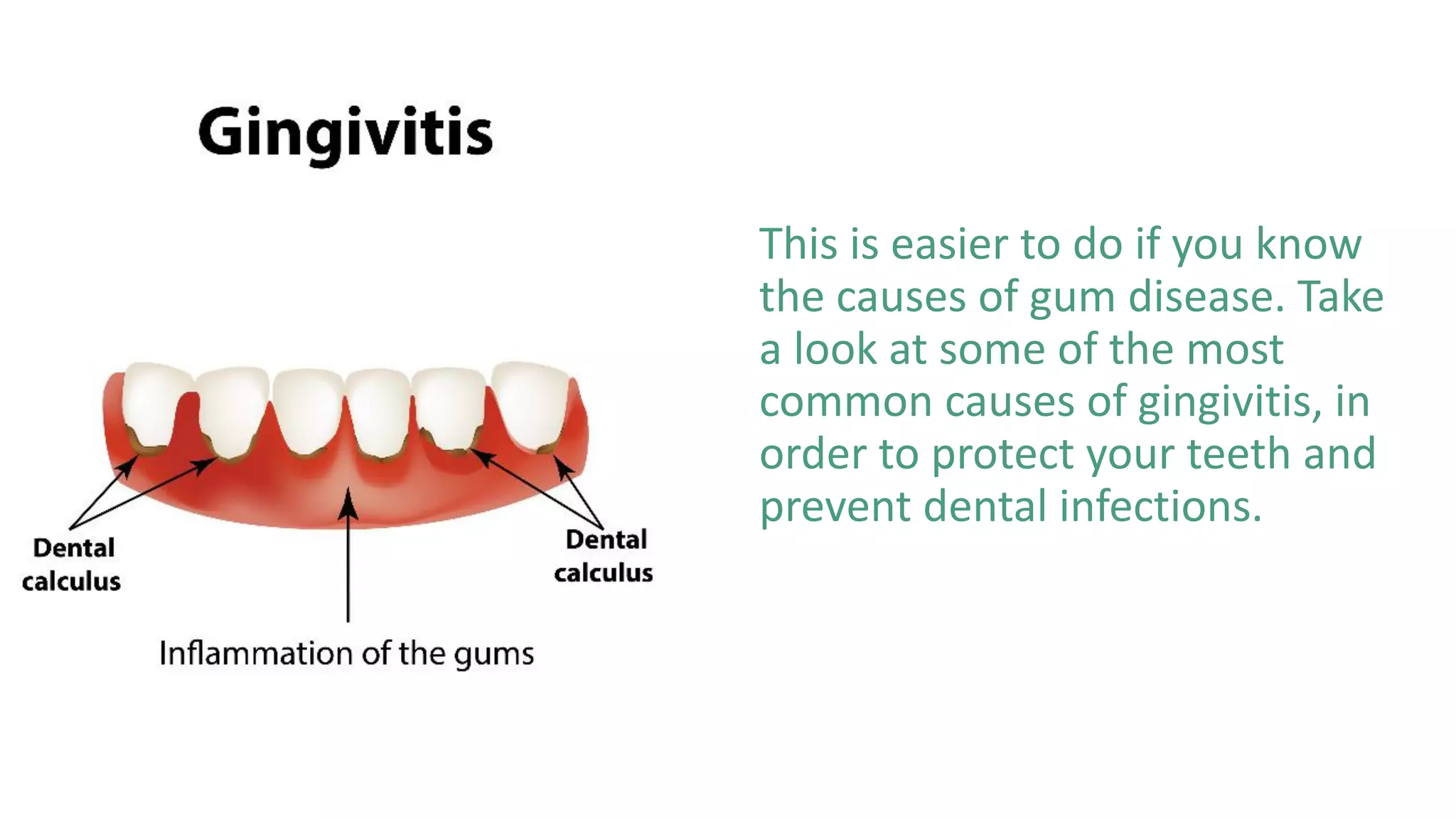 7 Causes of Gingivitis | PPT