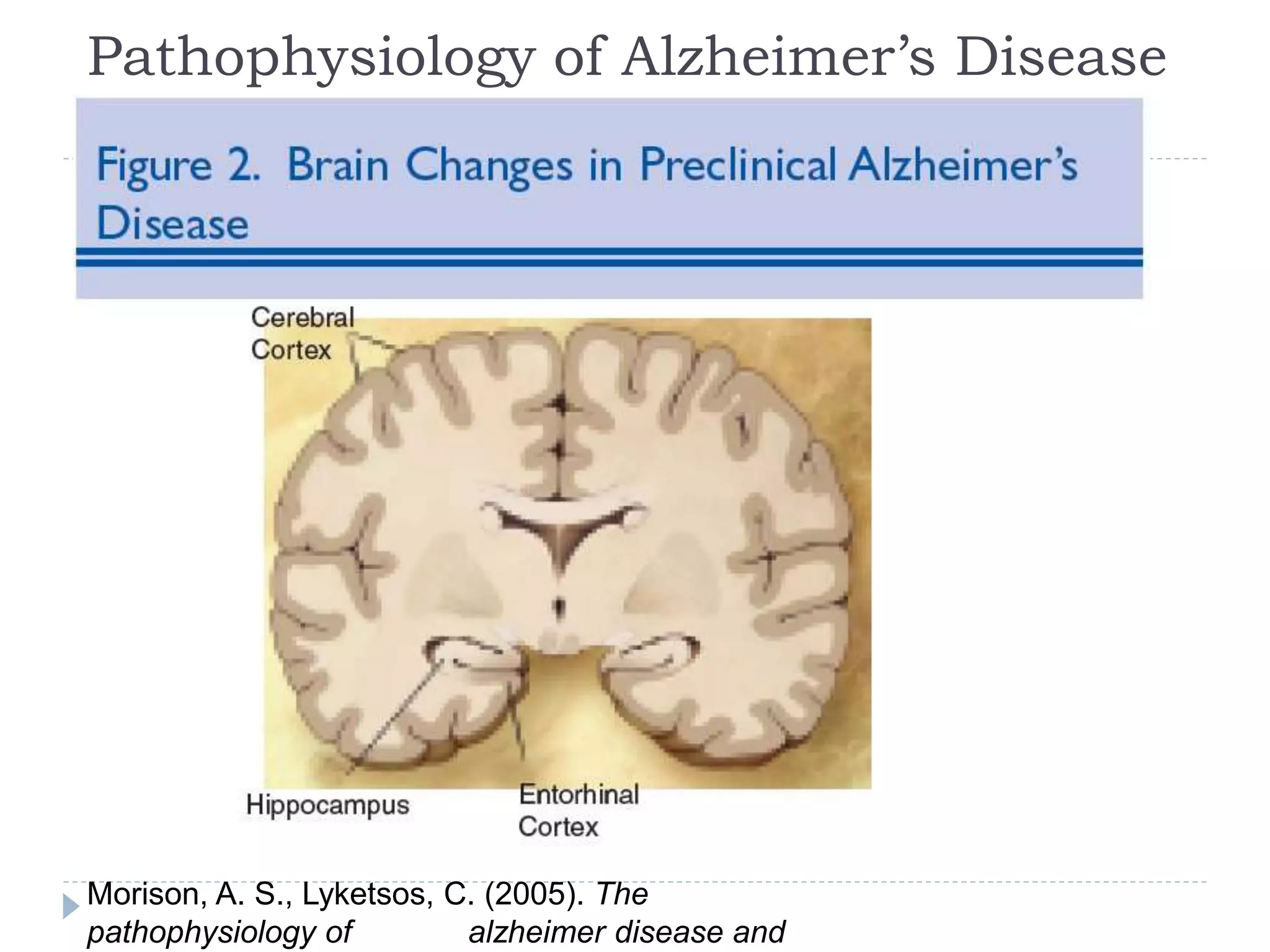 Alzheimer Disease | PPT