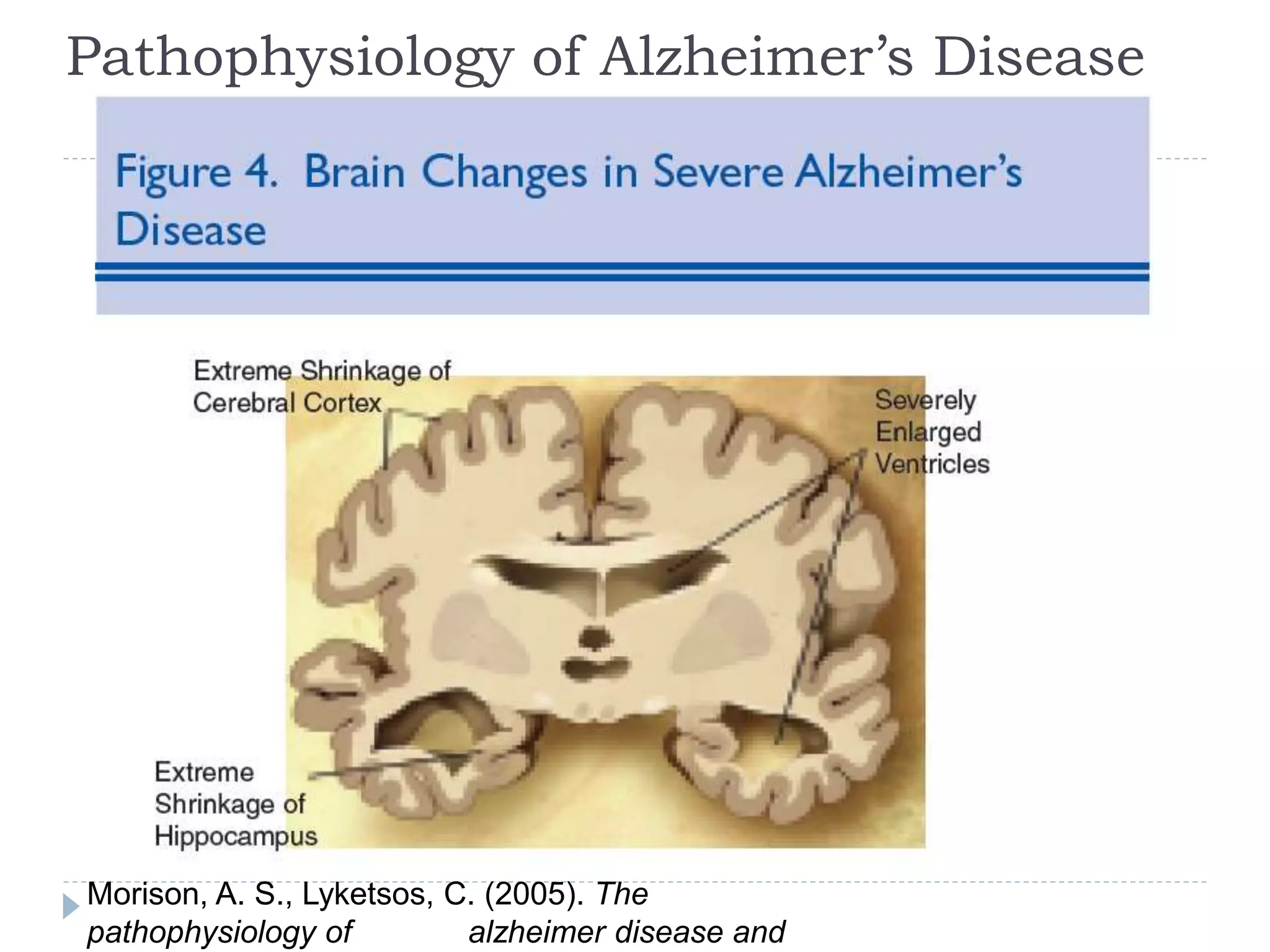 Alzheimer Disease | PPT