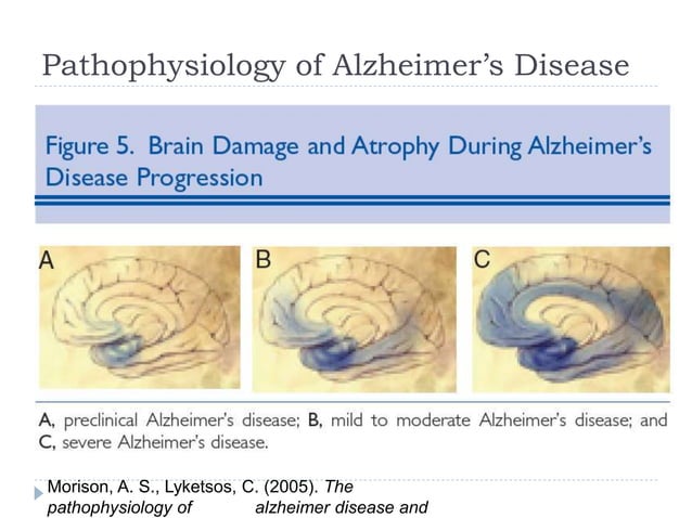 Alzheimer Disease | PPT