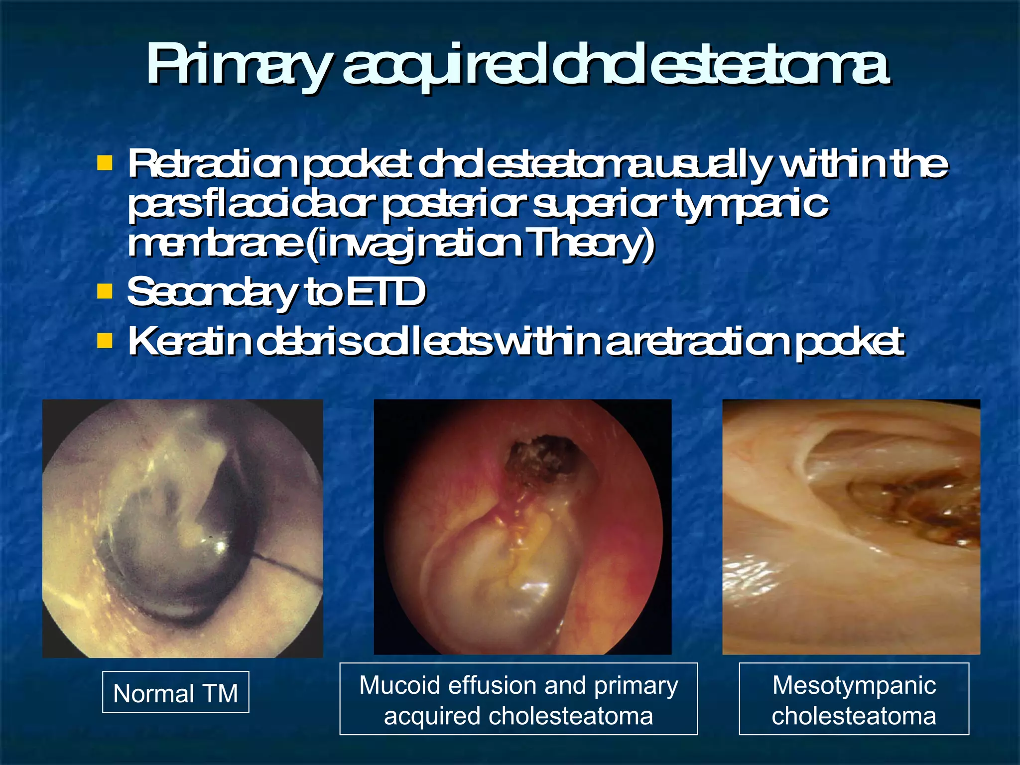 7 chronic suppurative otitis media with and without cholesteatoma | PPT