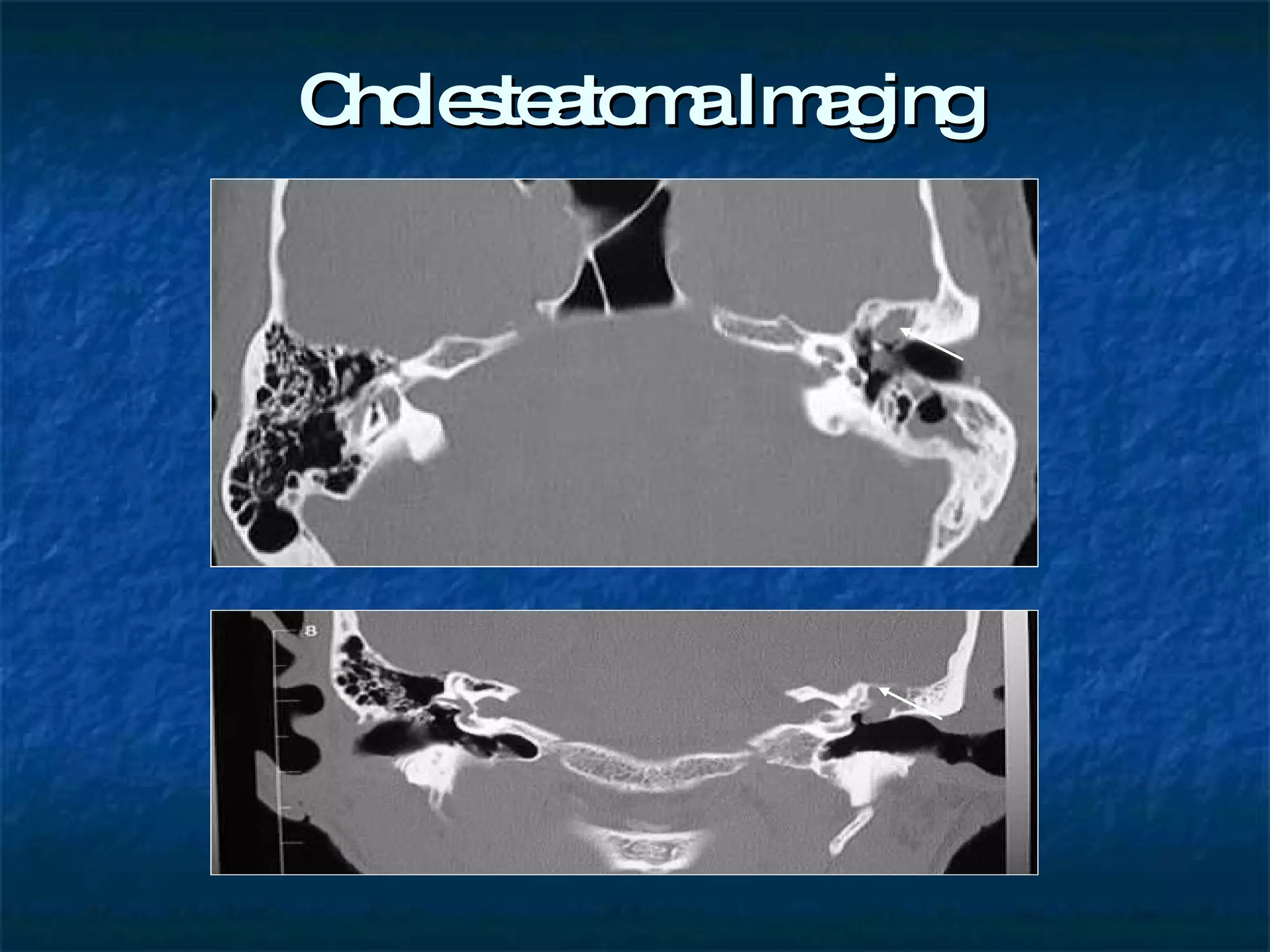 7 chronic suppurative otitis media with and without cholesteatoma | PPT
