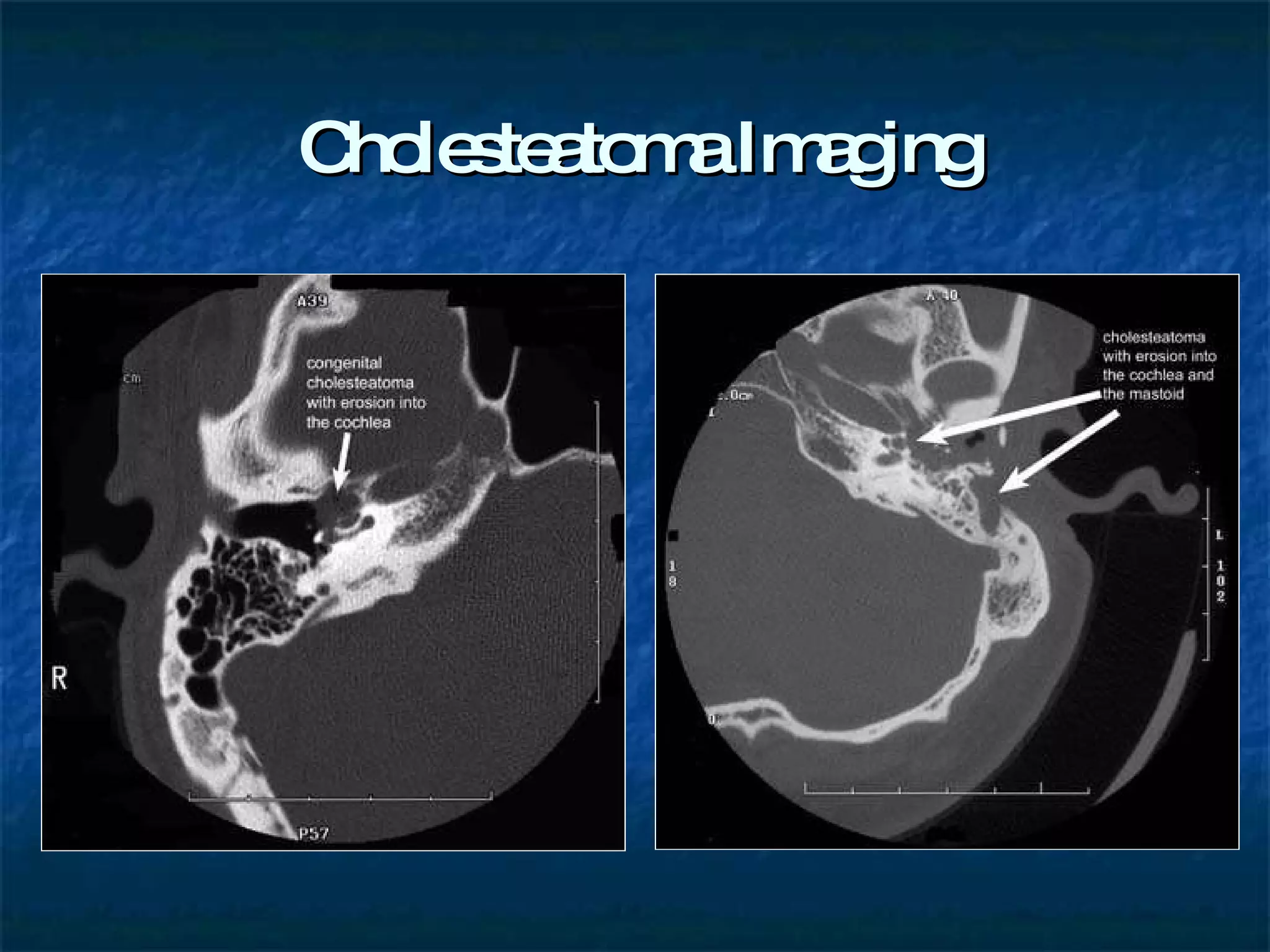 7 chronic suppurative otitis media with and without cholesteatoma | PPT