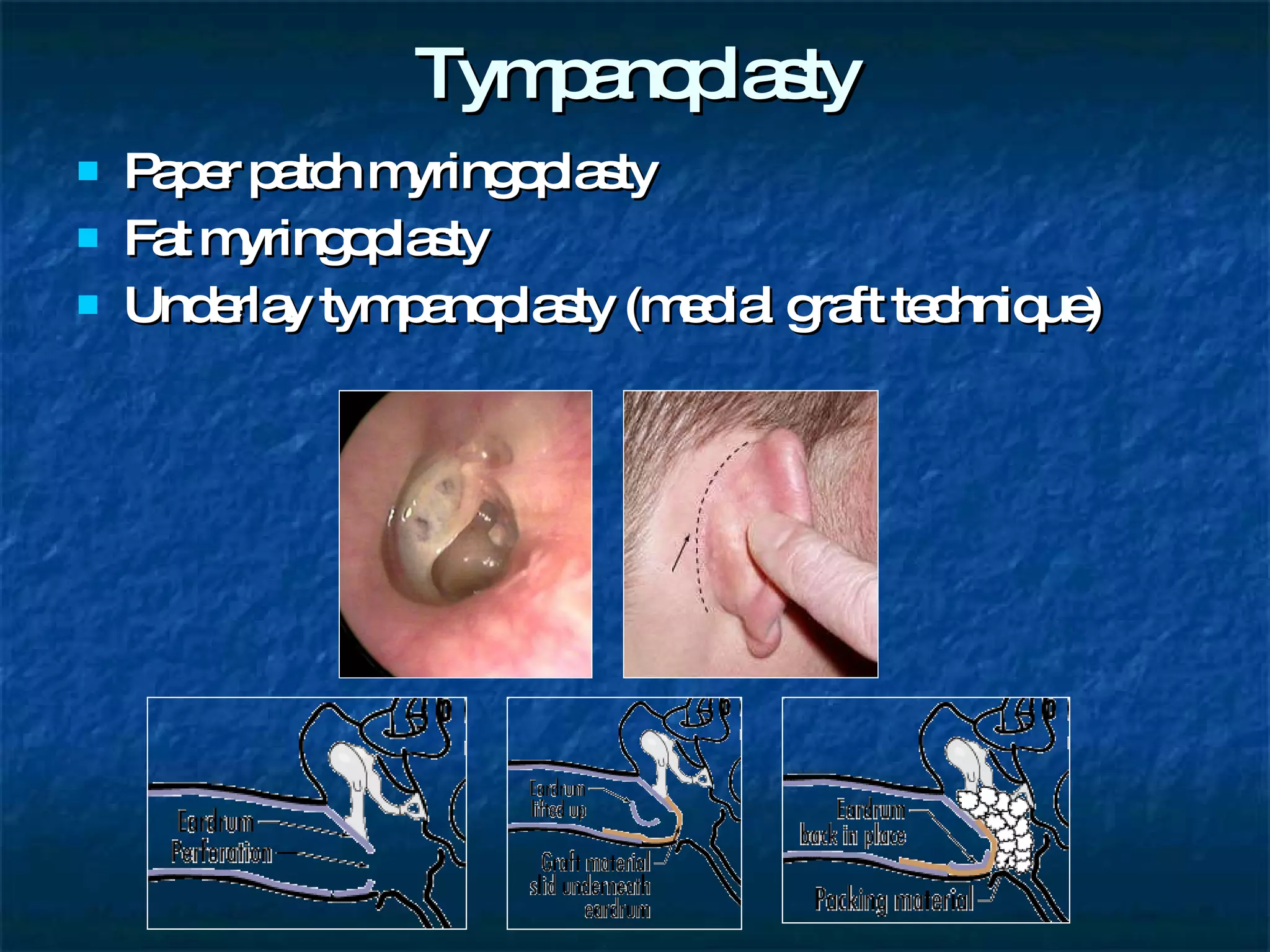7 chronic suppurative otitis media with and without cholesteatoma | PPT