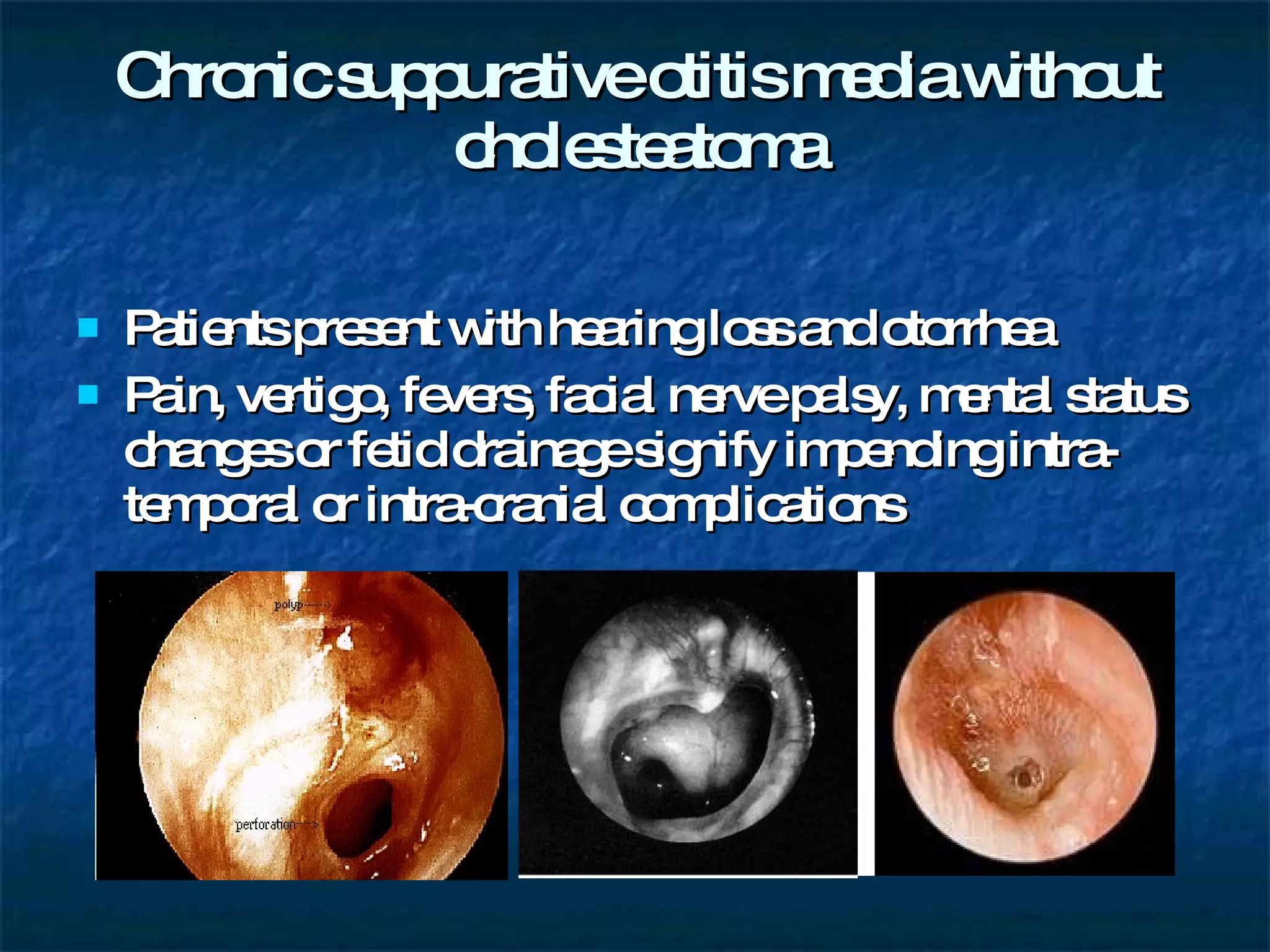 7 chronic suppurative otitis media with and without cholesteatoma | PPT