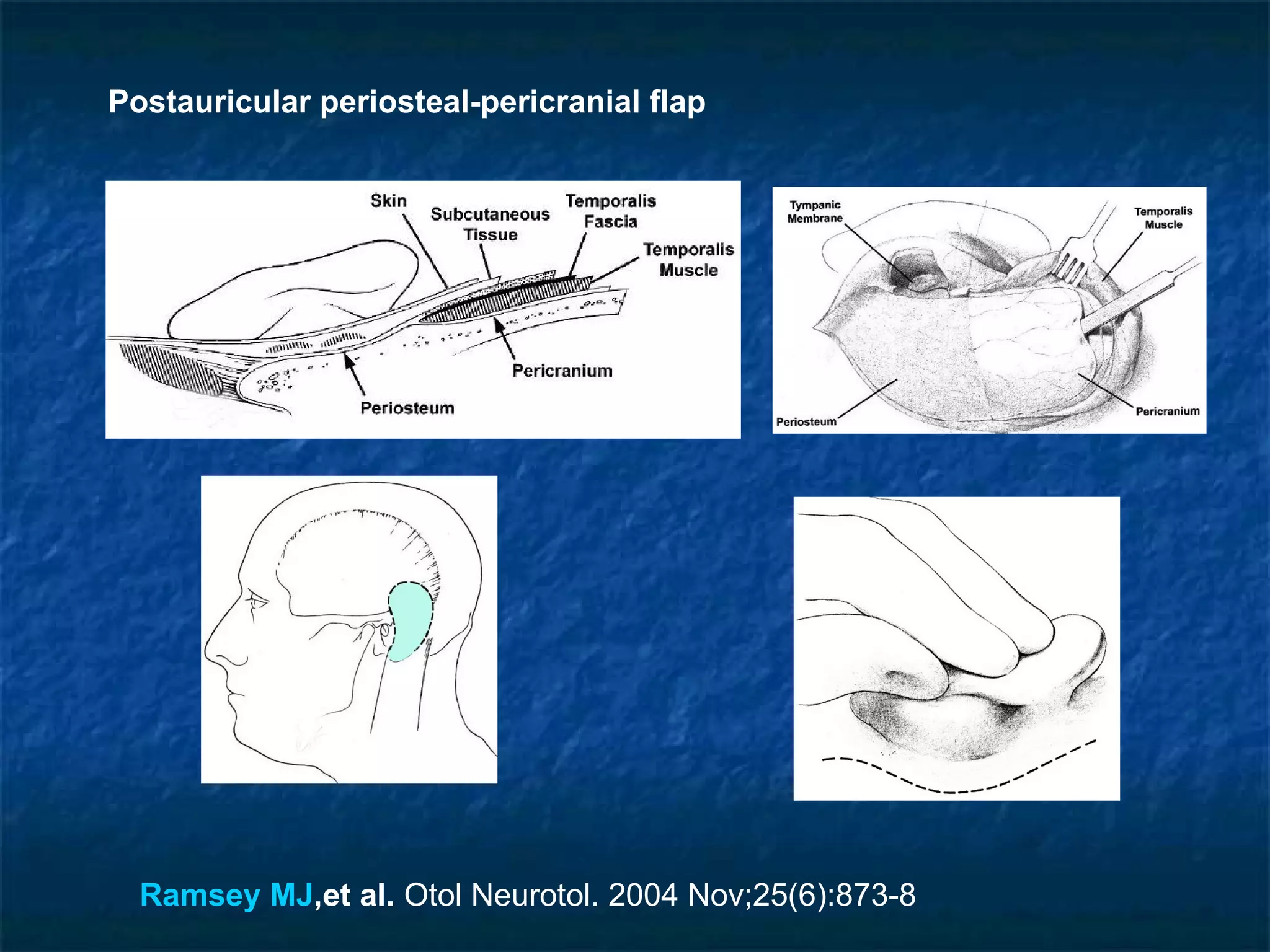 7 chronic suppurative otitis media with and without cholesteatoma | PPT