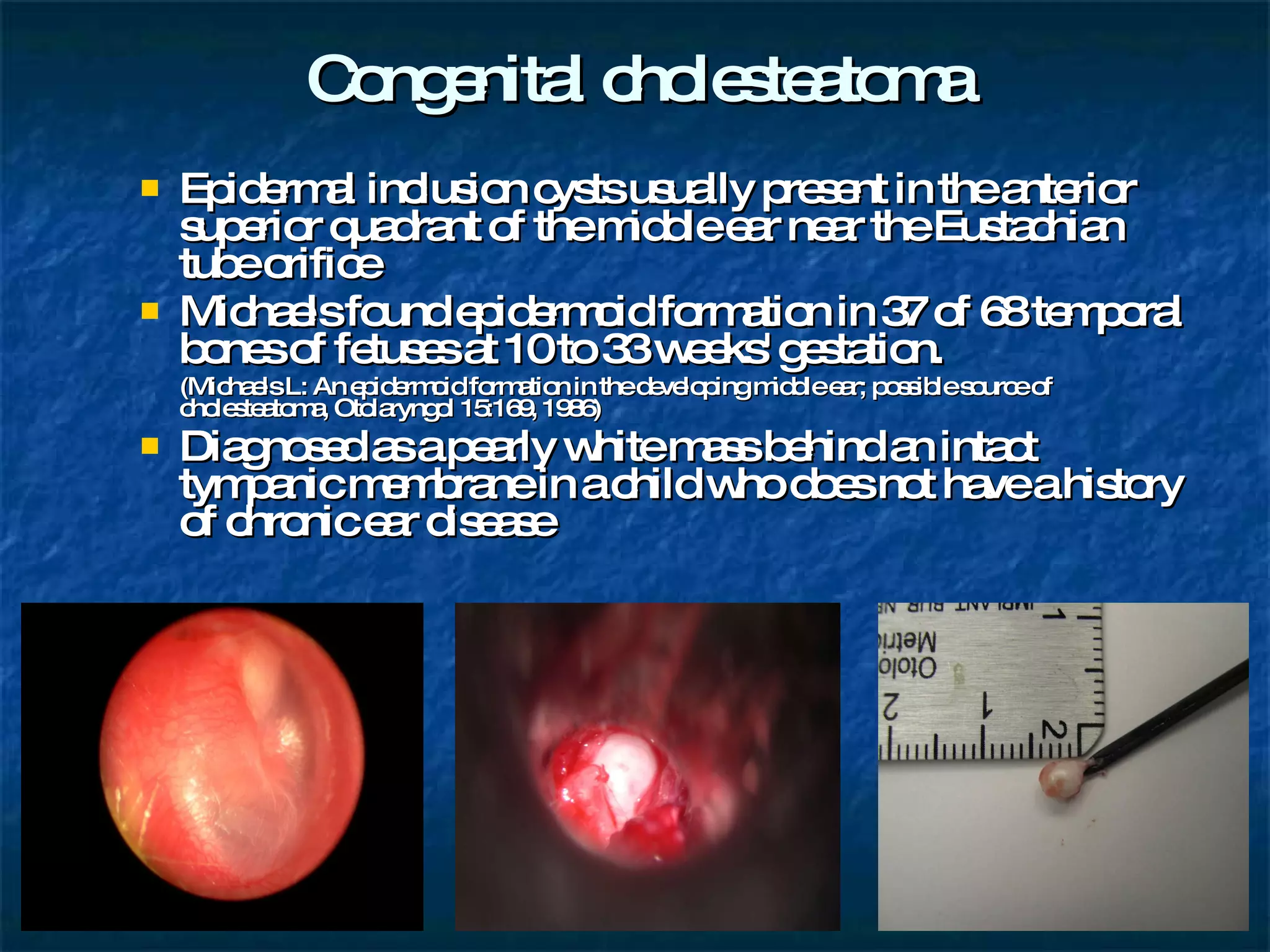 7 chronic suppurative otitis media with and without cholesteatoma | PPT