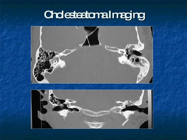 7 chronic suppurative otitis media with and without cholesteatoma | PPT