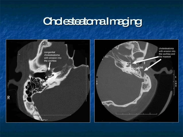7 chronic suppurative otitis media with and without cholesteatoma | PPT