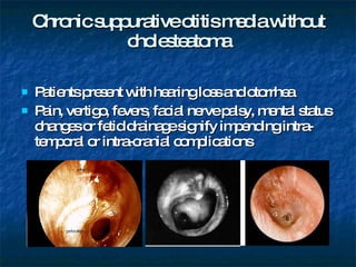 Chronic Suppurative Otitis Media With Cholesteatoma