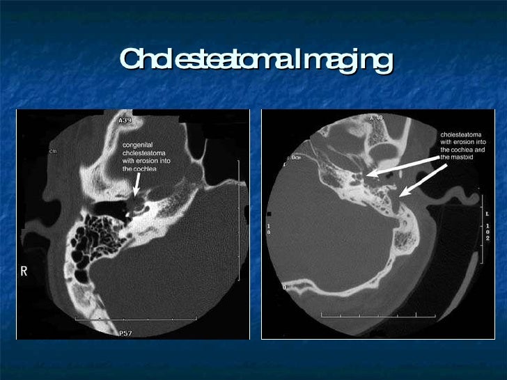 7 chronic suppurative otitis media with and without cholesteatoma