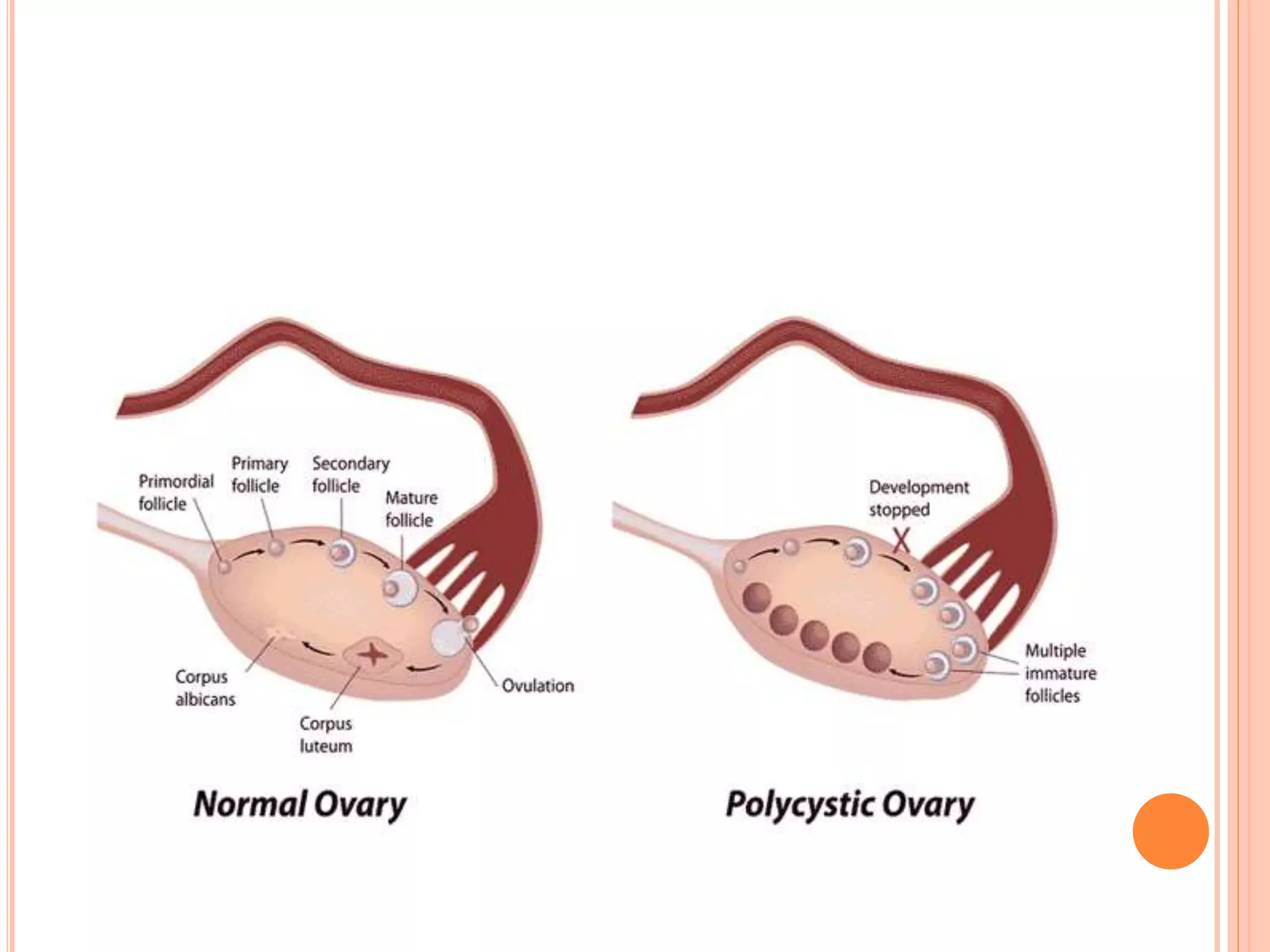 7 classical symptoms of pcos by dr.shailesh phalle | PPT