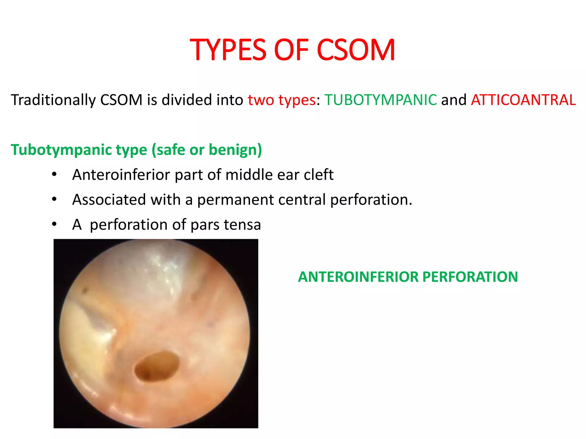 CHRONIC SUPPURATIVE OTITIS MEDIA (TUBOTYMPANIC) | PPT