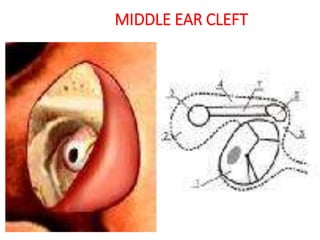 CHRONIC SUPPURATIVE OTITIS MEDIA (TUBOTYMPANIC) | PPT