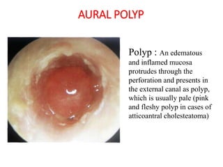 CHRONIC SUPPURATIVE OTITIS MEDIA (TUBOTYMPANIC) | PPT