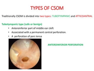CHRONIC SUPPURATIVE OTITIS MEDIA (TUBOTYMPANIC) | PPT