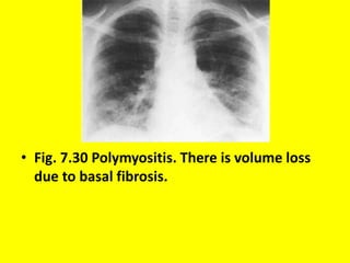 7 diffuse lung disease | PPTX